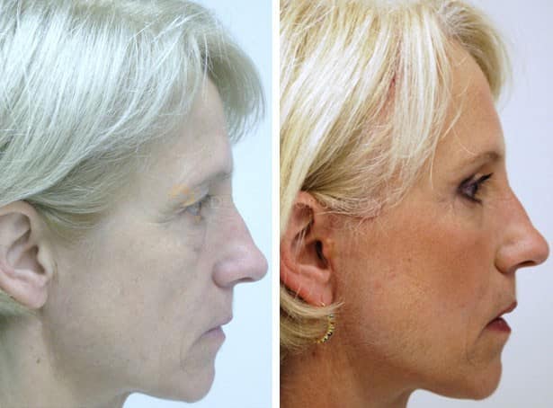 Neck Lift Photos | Before and After Profile Results