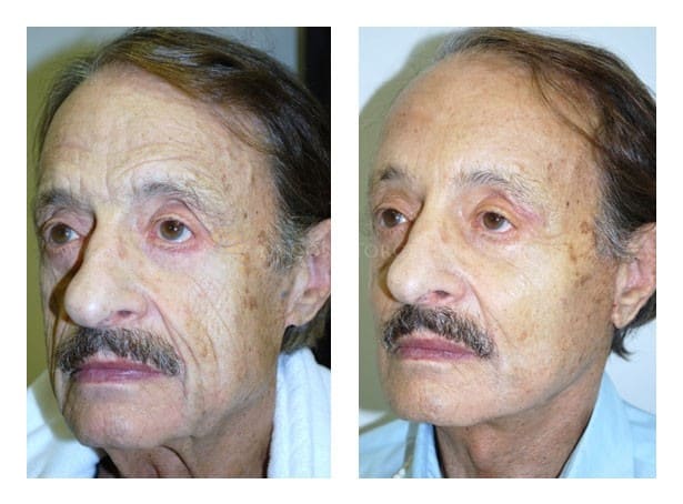 Neck Lift Photos | Before and After Profile Results