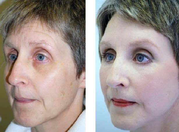 Brow Lift Before & After Gallery | Dr. Cory Torgerson