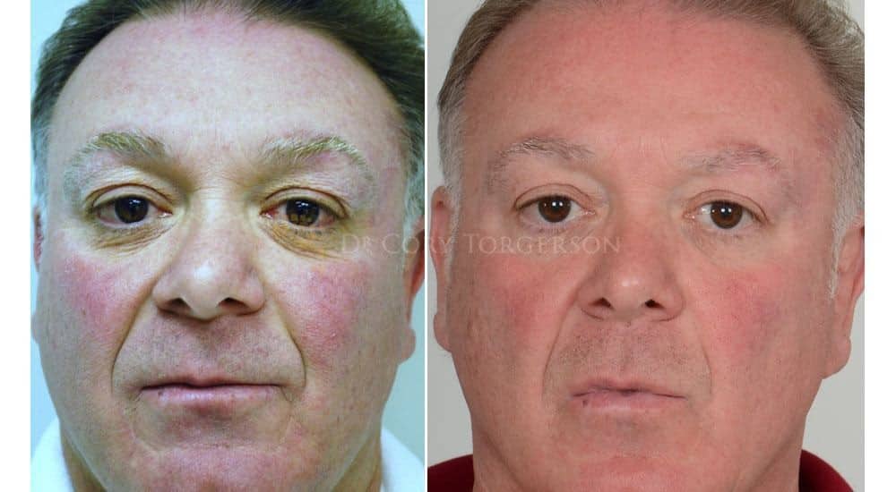 Facelift Before & After Gallery | Dr. Cory Torgerson