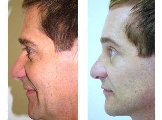 Neck Lift Photos | Before and After Profile Results