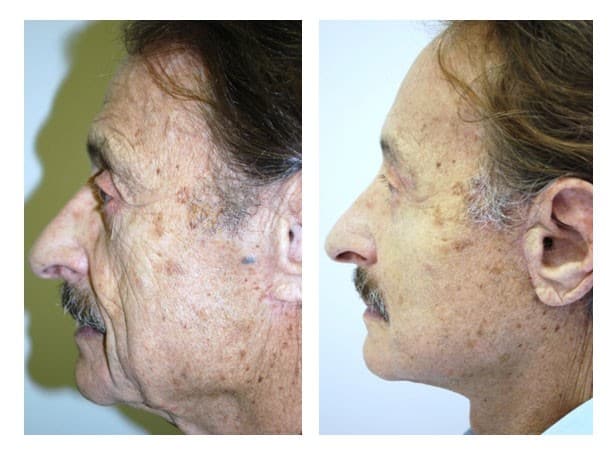 Neck Lift Photos | Before and After Profile Results