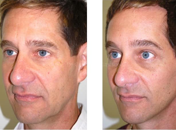 Neck Lift Photos | Before and After Profile Results