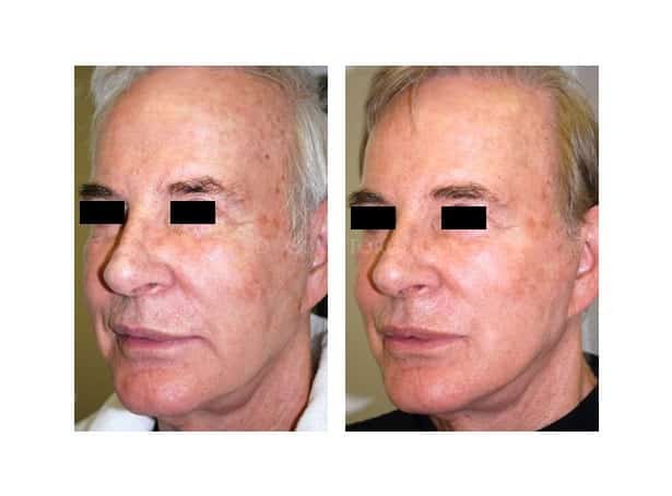 Neck Lift Photos | Before and After Profile Results