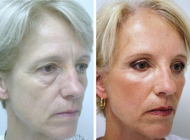 Facelift Before & After Gallery | Dr. Cory Torgerson