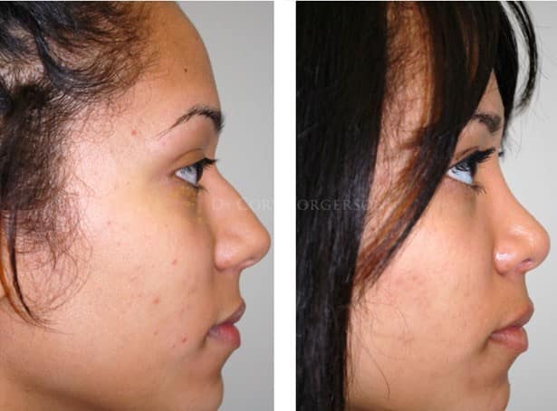 Before & After Gallery - Surgical & Non Surgical Plastic Surgery