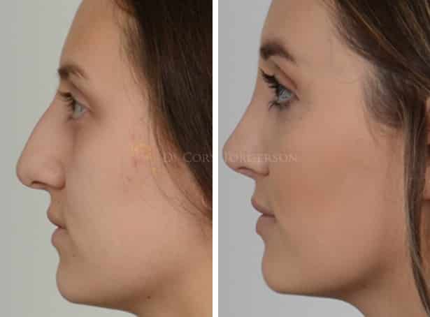 Before & After Gallery - Surgical & Non Surgical Plastic Surgery