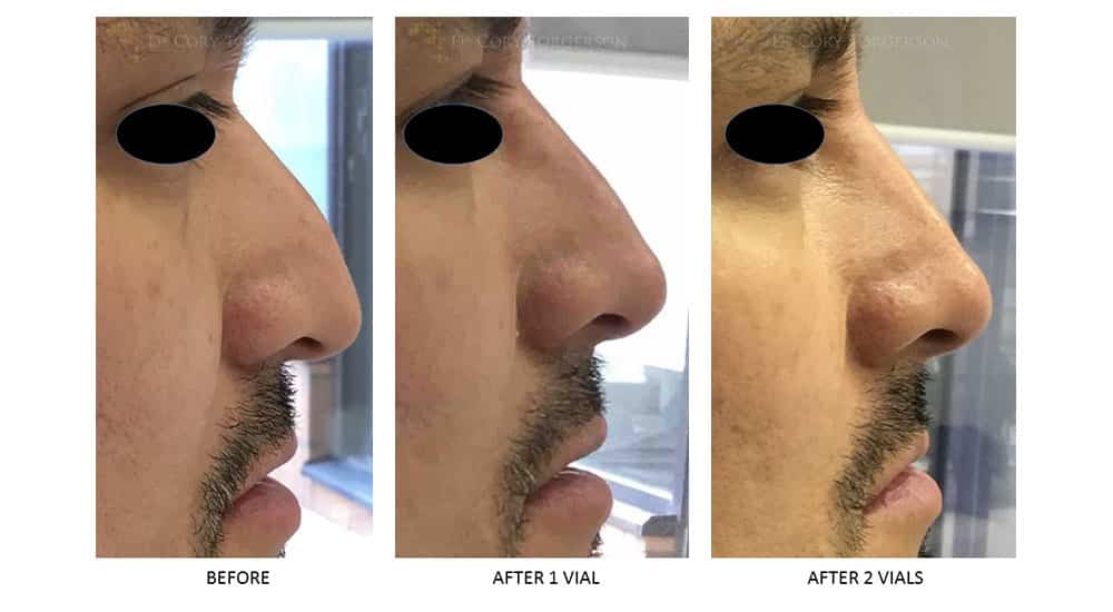 Non Surgical Nose Job Before & After Gallery | Dr. Cory Torgerson