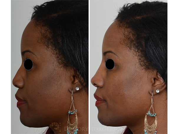 Non Surgical Nose Job Before & After Gallery | Dr. Cory Torgerson