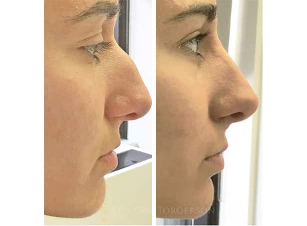 Non Surgical Nose Job Before & After Gallery | Dr. Cory Torgerson