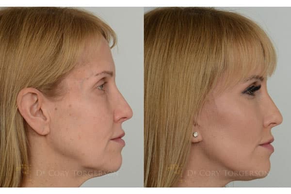 Facelift Before & After Gallery | Dr. Cory Torgerson