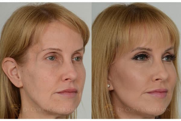 Facelift Before & After Gallery | Dr. Cory Torgerson