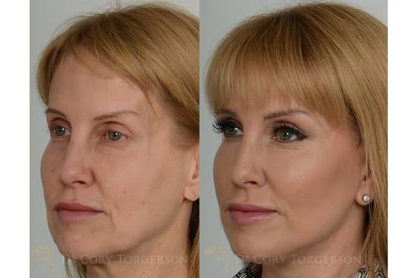 Facelift Before & After Gallery | Dr. Cory Torgerson