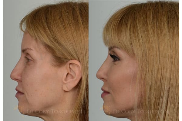 Facelift Before & After Gallery | Dr. Cory Torgerson
