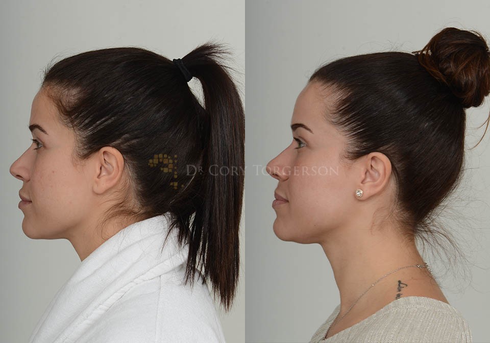 Chin Implant Photos | Before and After Profile Gallery