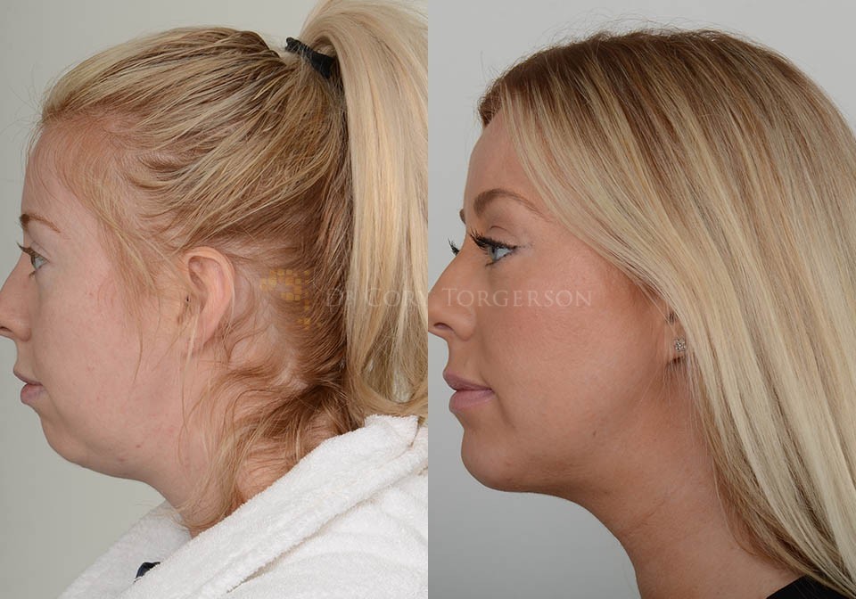 Chin Implant Photos | Before and After Profile Gallery