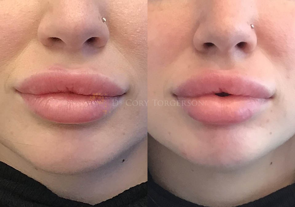 Botox Lips Before After Lipstutorial