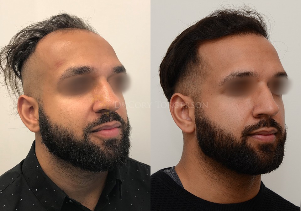 FUE Hair Transplant Before & After Gallery | Dr. Cory Torgerson