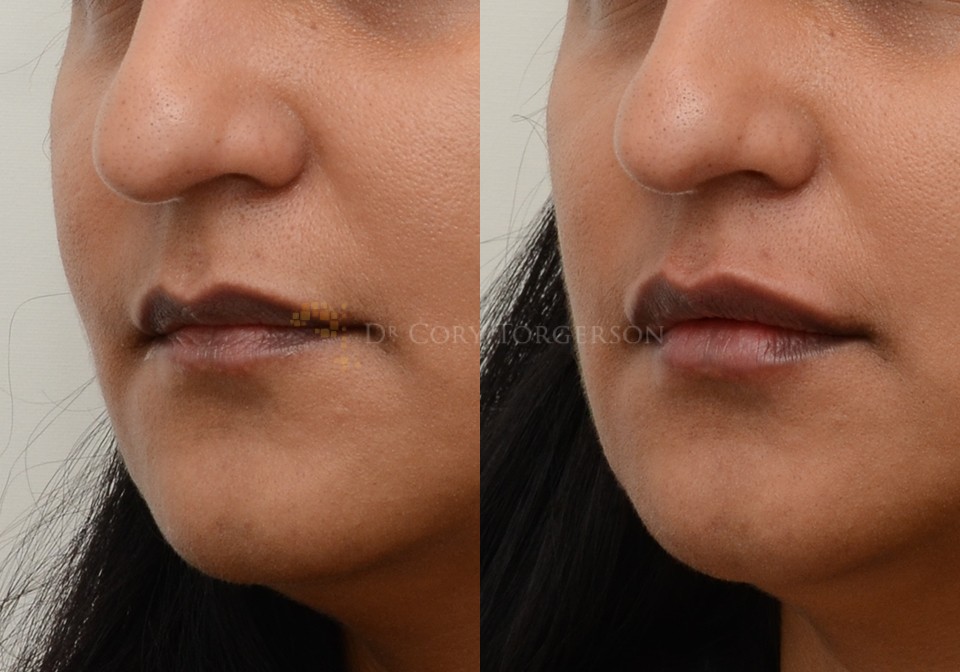 Lip Fillers Before & After Gallery | Dr. Cory Torgerson