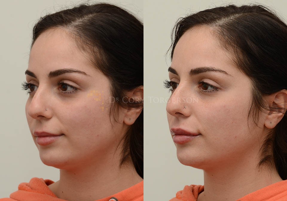 Lip Fillers Before & After Gallery | Dr. Cory Torgerson