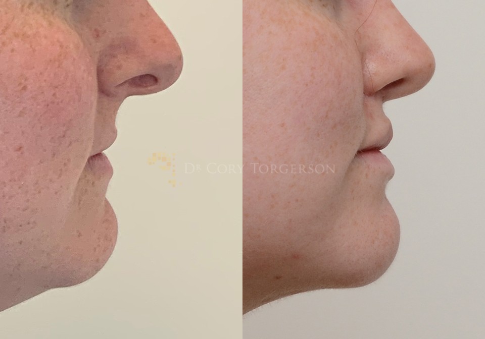 Lip Lift Before & After Gallery | Dr. Cory Torgerson