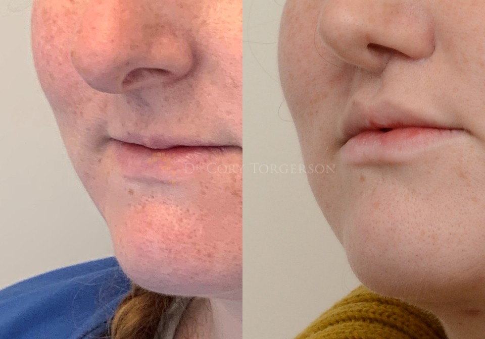 Lip Lift Before & After Gallery | Dr. Cory Torgerson
