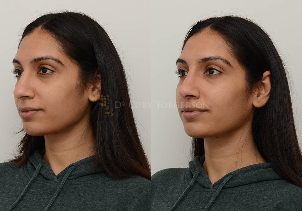 Non Surgical Nose Job Before & After Gallery | Dr. Cory Torgerson