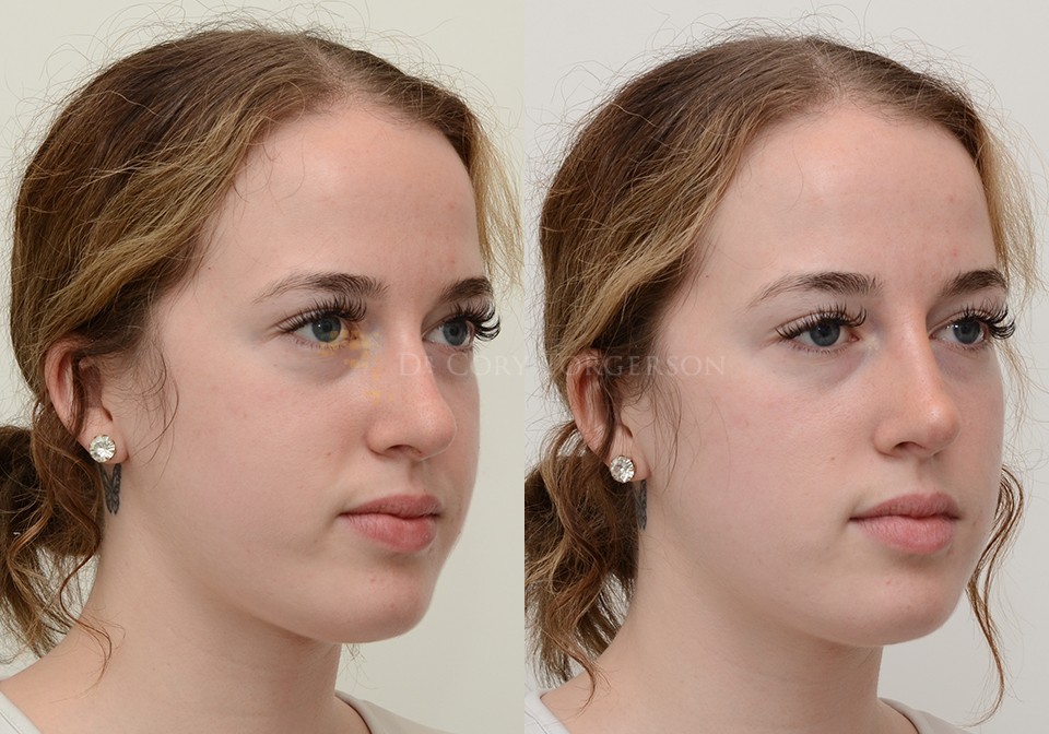 Non Surgical Nose Job Before & After Gallery | Dr. Cory Torgerson