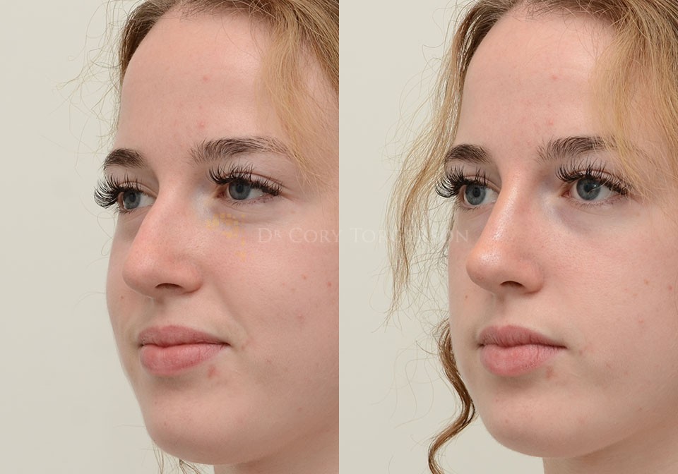 Non Surgical Nose Job Before & After Gallery | Dr. Cory Torgerson