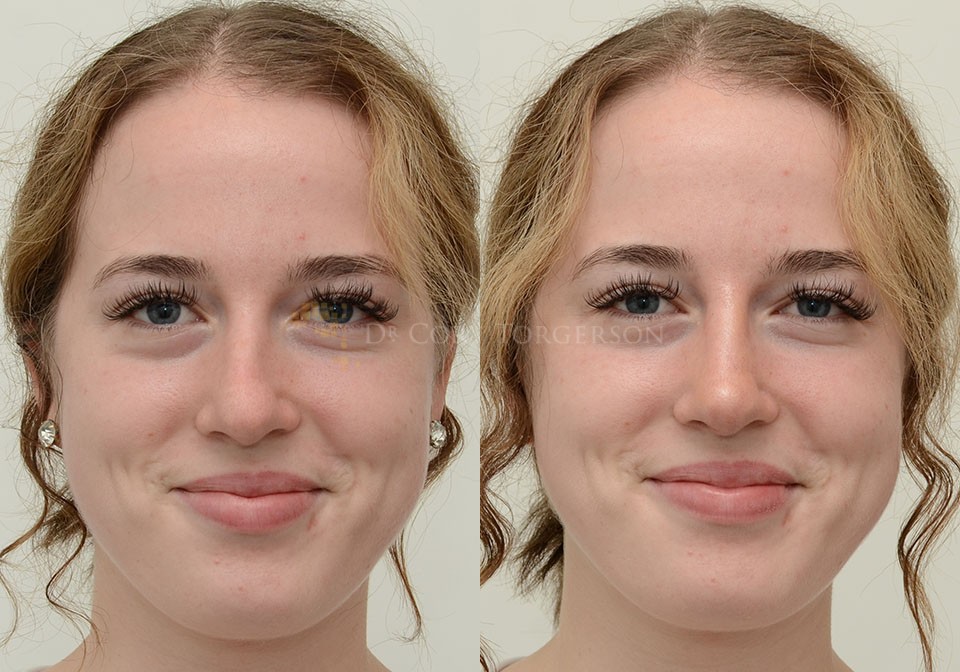 Non Surgical Nose Job Before & After Gallery | Dr. Cory Torgerson