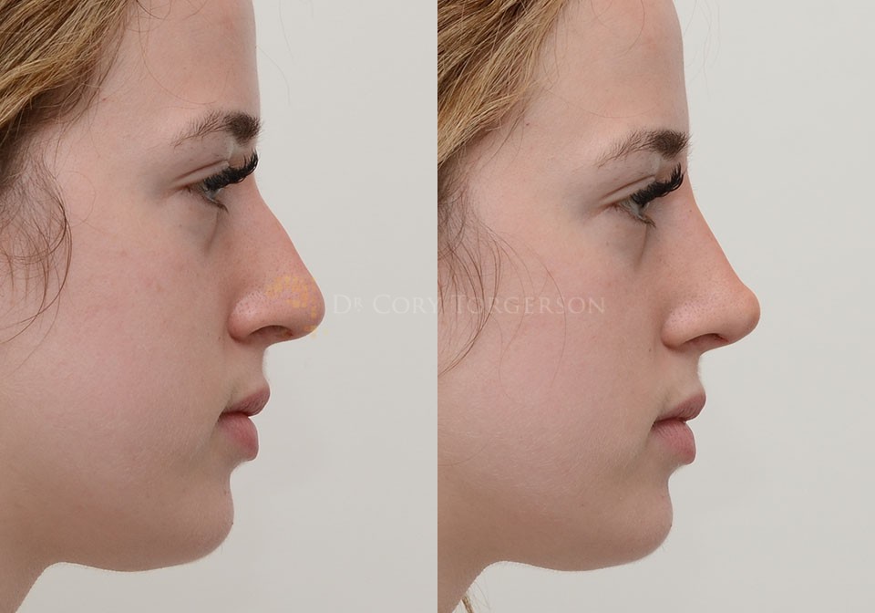 Non Surgical Nose Job Before & After Gallery | Dr. Cory Torgerson