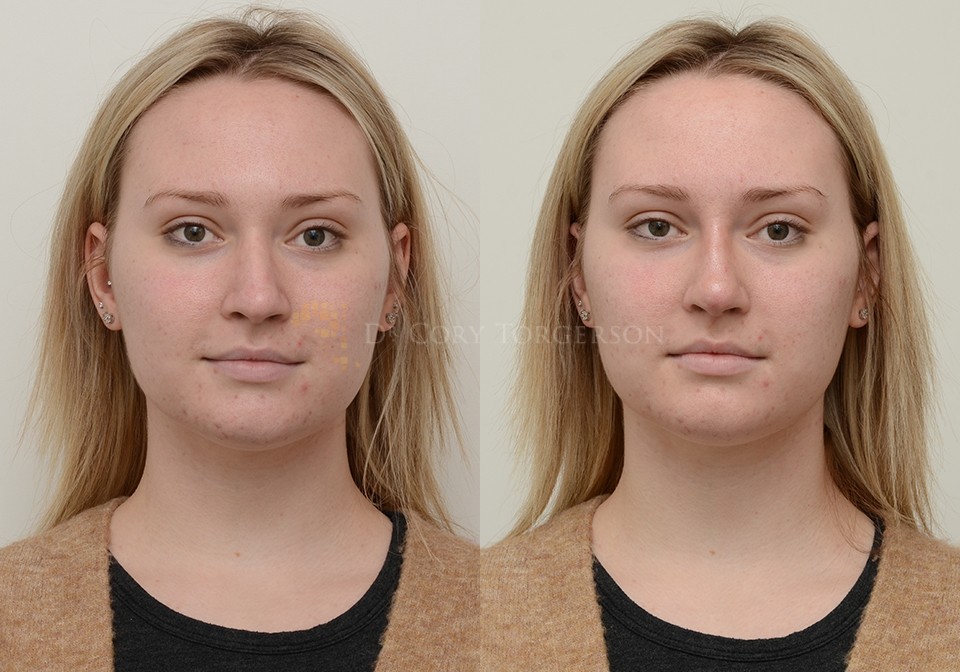 Non Surgical Nose Job Before & After Gallery | Dr. Cory Torgerson