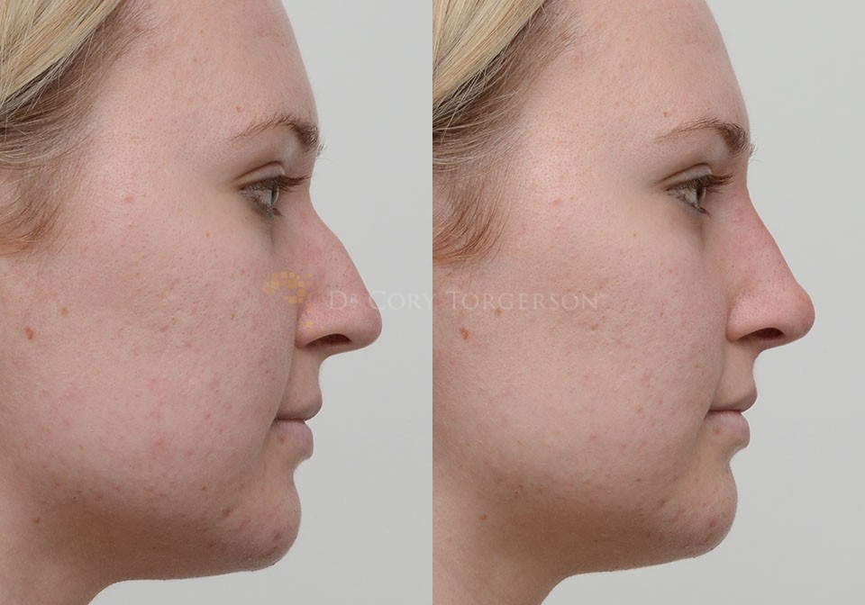 Non Surgical Nose Job Before & After Gallery | Dr. Cory Torgerson