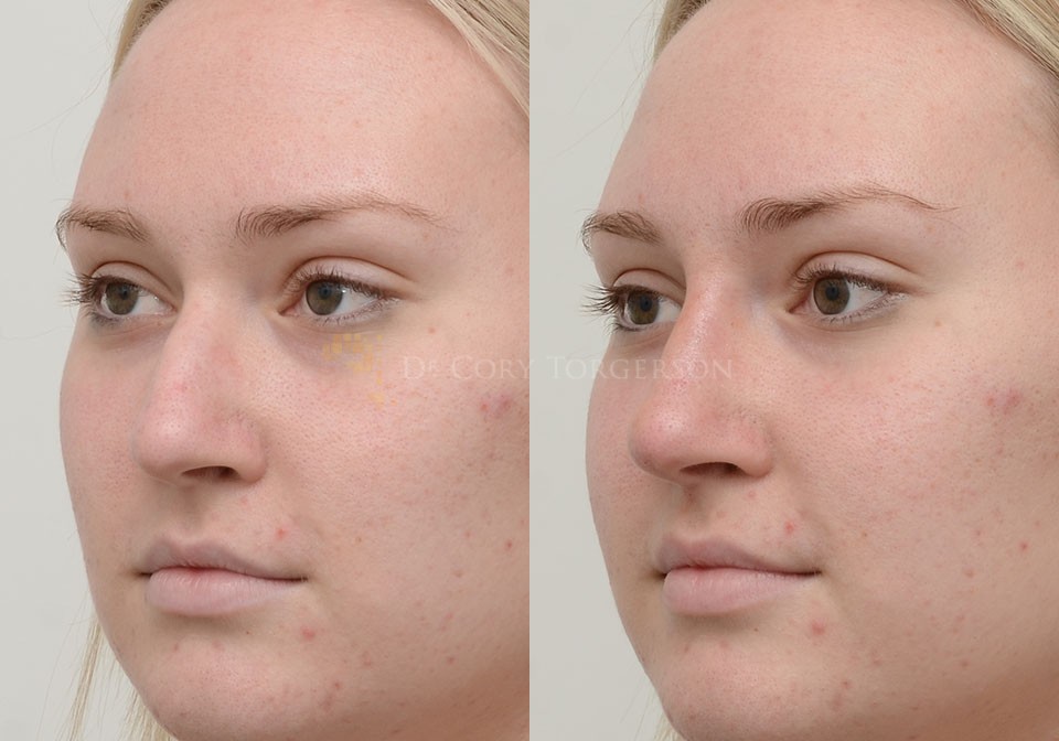 Non Surgical Nose Job Before & After Gallery | Dr. Cory Torgerson