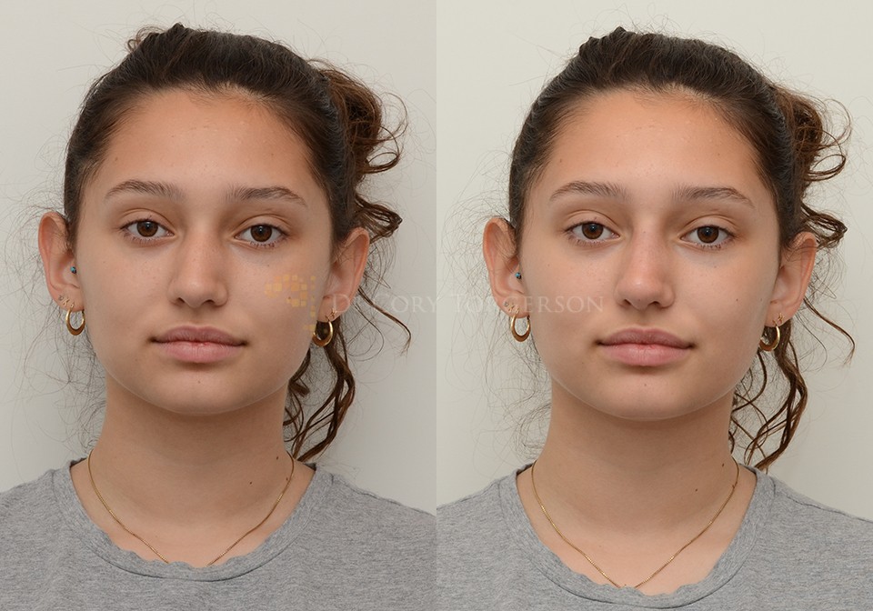 Non Surgical Nose Job Before & After Gallery | Dr. Cory Torgerson