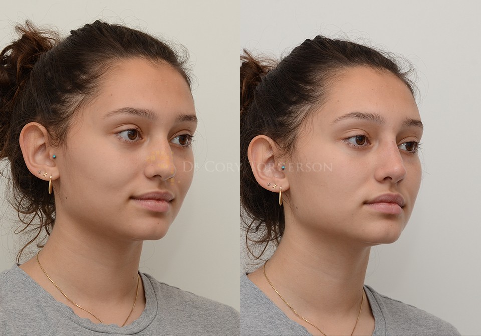 Non Surgical Nose Job Before & After Gallery | Dr. Cory Torgerson