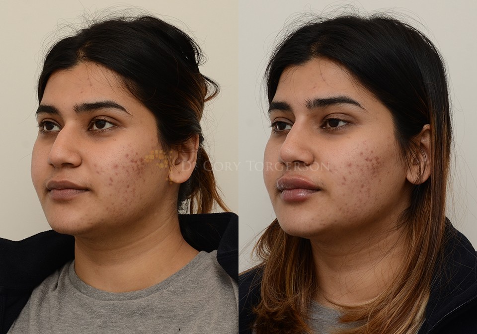 Non Surgical Nose Job Before & After Gallery | Dr. Cory Torgerson