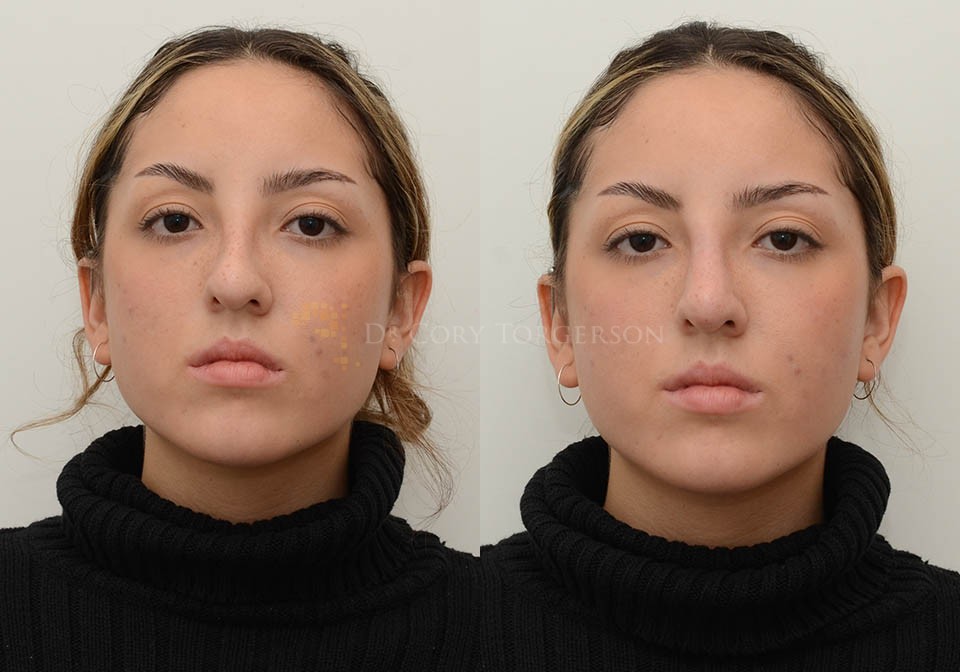 Non Surgical Nose Job Before & After Gallery | Dr. Cory Torgerson