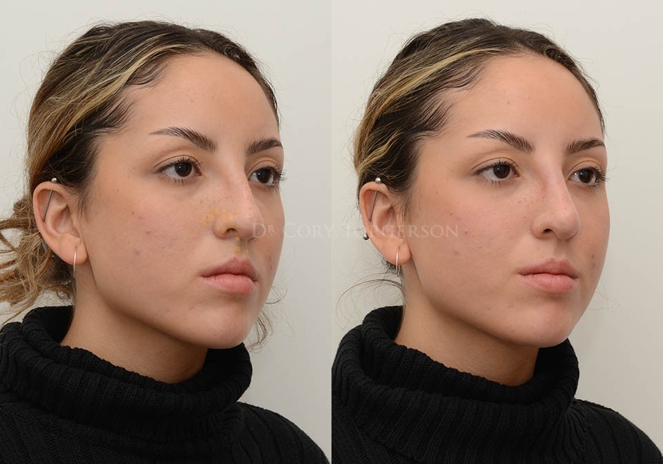 Non Surgical Nose Job Before & After Gallery | Dr. Cory Torgerson