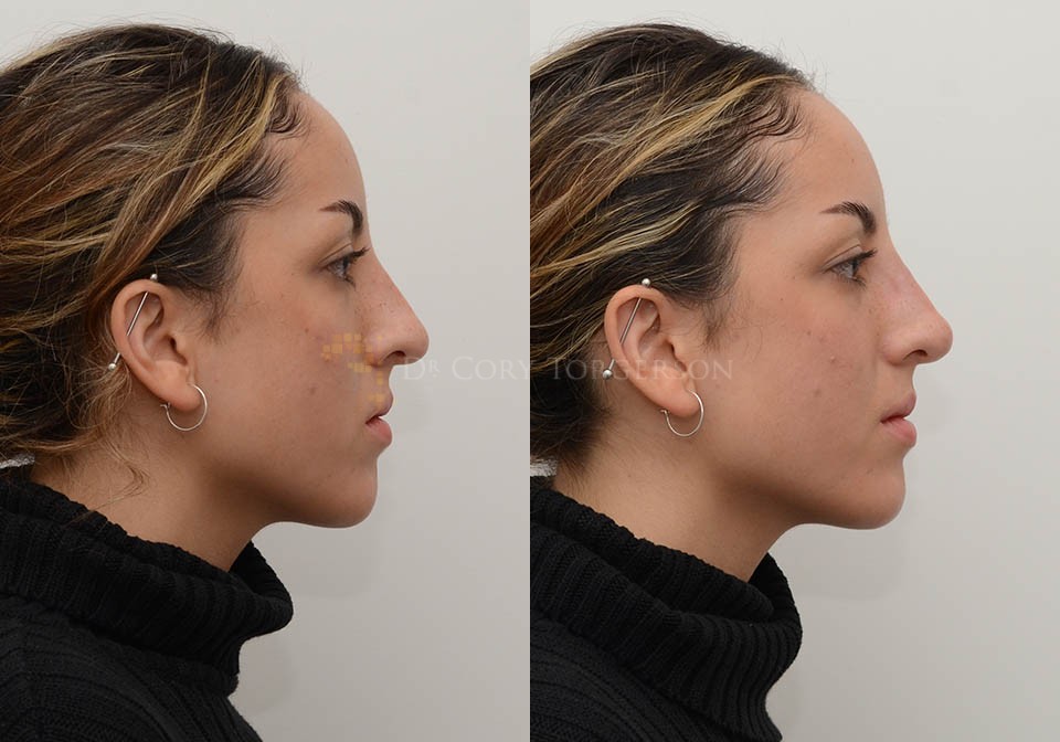 Non Surgical Nose Job Before & After Gallery | Dr. Cory Torgerson