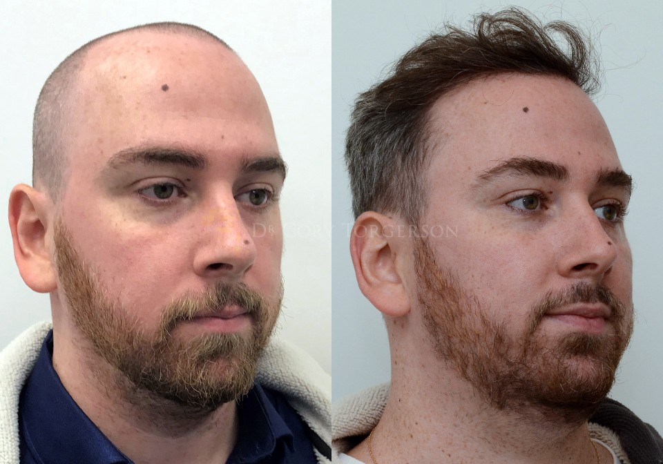 FUE Hair Transplant Before & After Gallery | Dr. Cory Torgerson