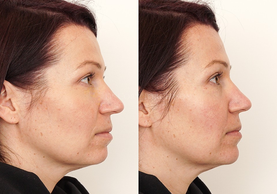 Chin Fillers Before & After Gallery | Dr. Cory Torgerson