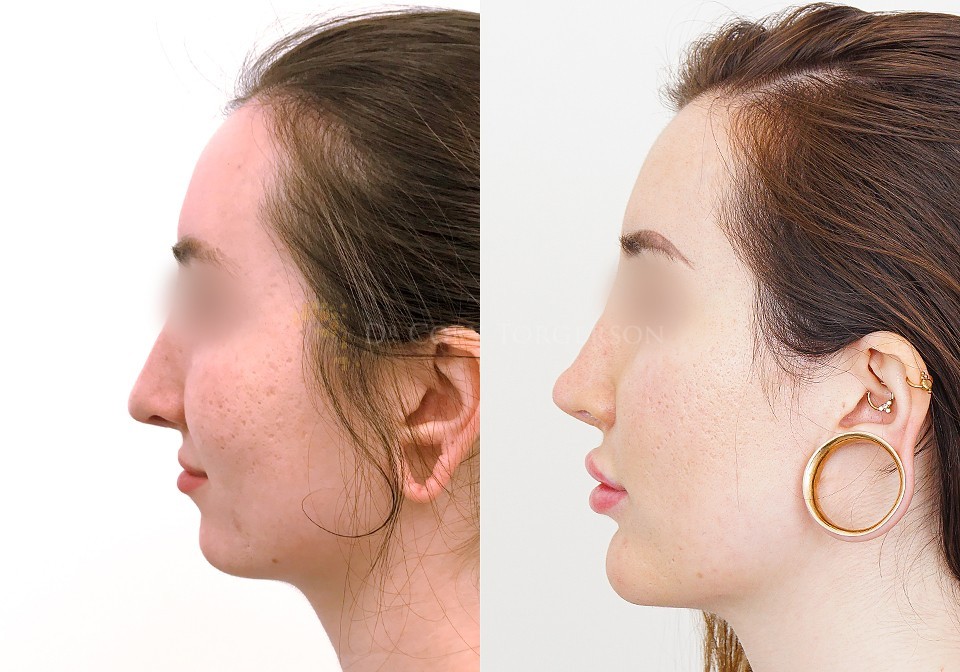 Chin Fillers Photos | Before and After Jawline Gallery