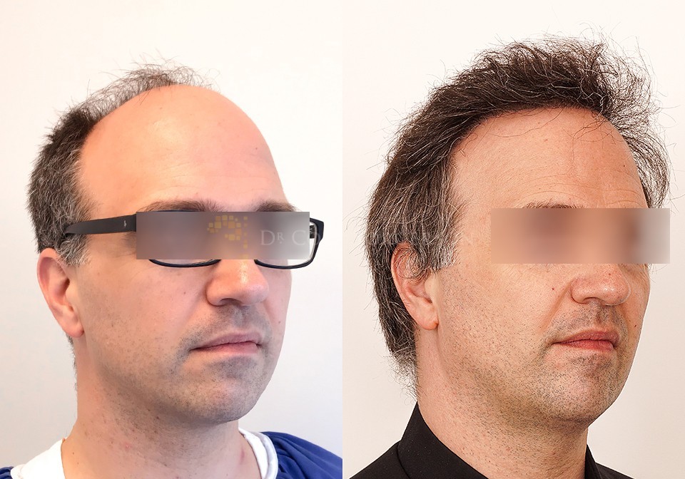 FUE Hair Transplant Before & After Gallery | Dr. Cory Torgerson