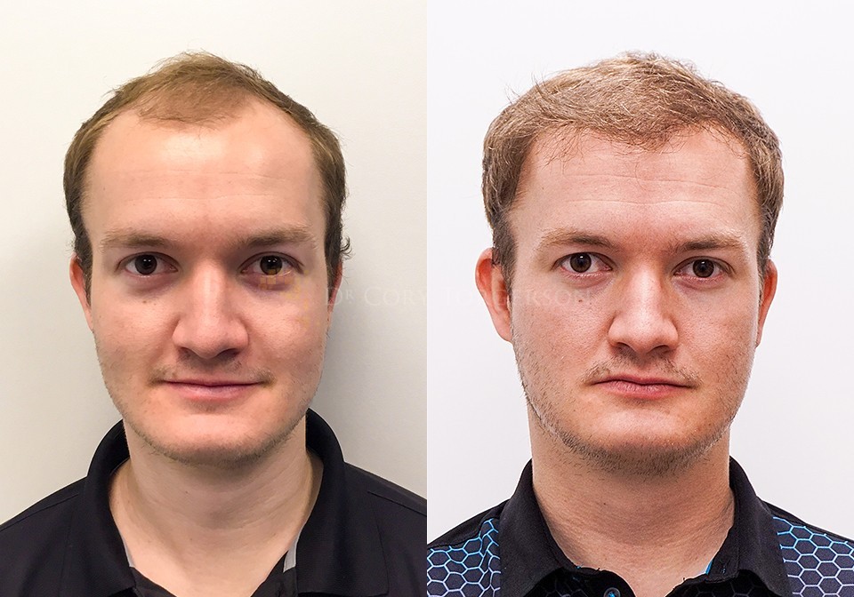 FUE Hair Transplant Before & After Gallery | Dr. Cory Torgerson