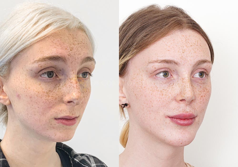 Rhinoplasty Before & After Gallery | Dr. Cory Torgerson