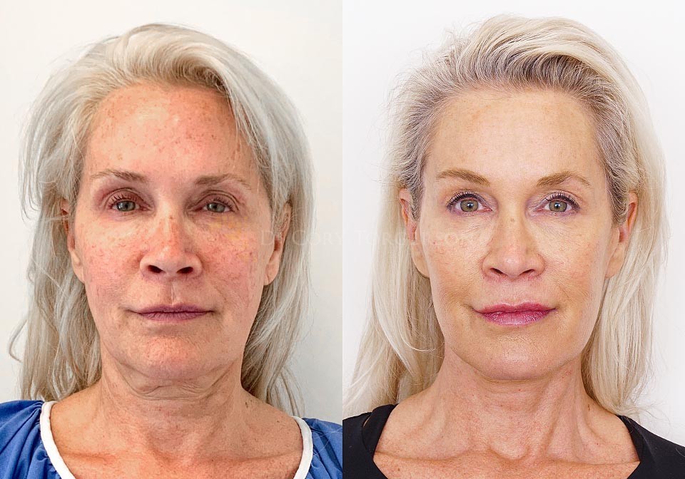Neck Lift Before & After Gallery | Dr. Cory Torgerson