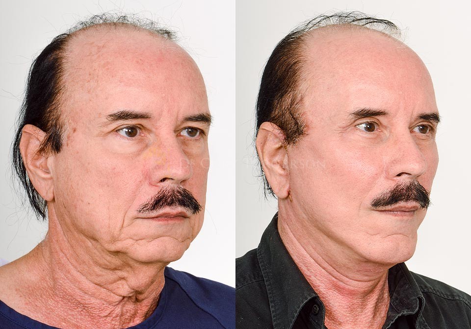Facelift Before & After Gallery | Dr. Cory Torgerson