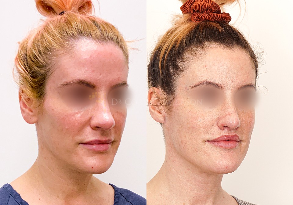 Lip Lift Before & After Gallery | Dr. Cory Torgerson