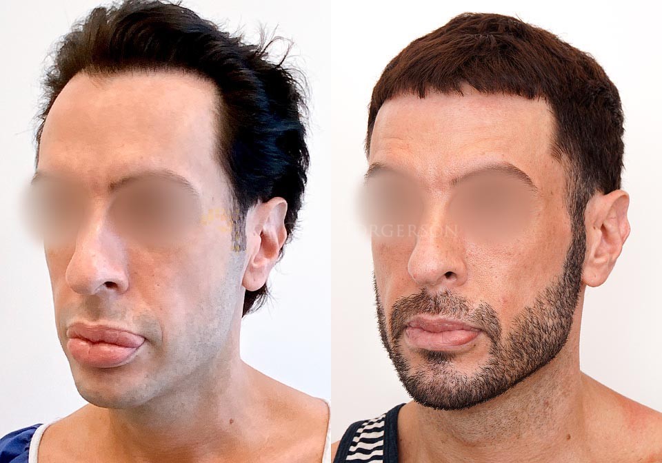 Lip Reduction Before & After Gallery | Dr. Cory Torgerson